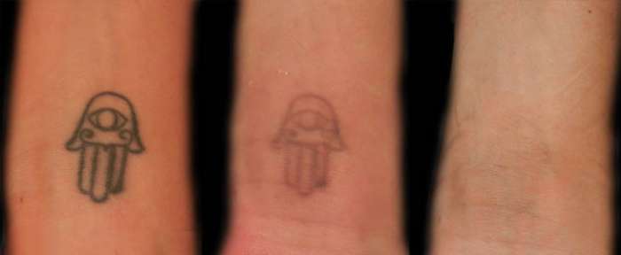 Rimozione Tatuaggio Metodi Risultati E Effetti Collaterali Delle